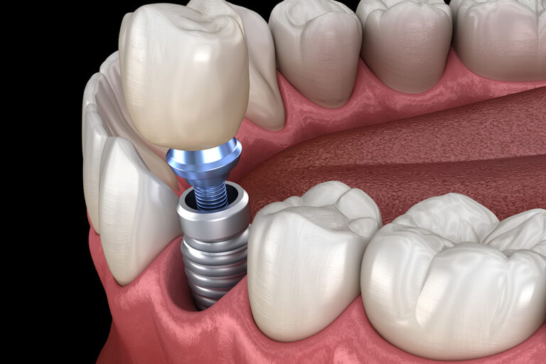Lowell Dental Arts Explain the Types of Dental Implants Available